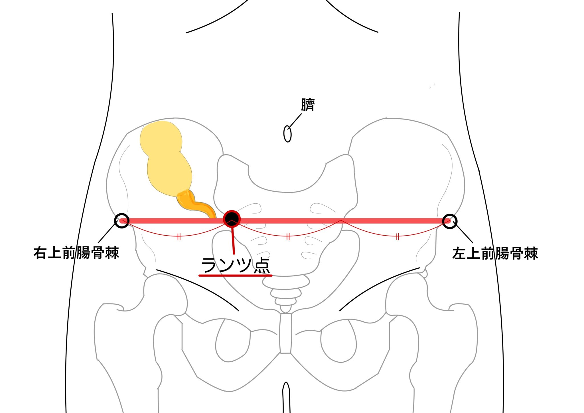 【虫垂炎の圧痛点】試験前に不安ならコレ！マックバーニー点・ランツ点を一発で覚える方法【医学生道場】 | 医学生道場