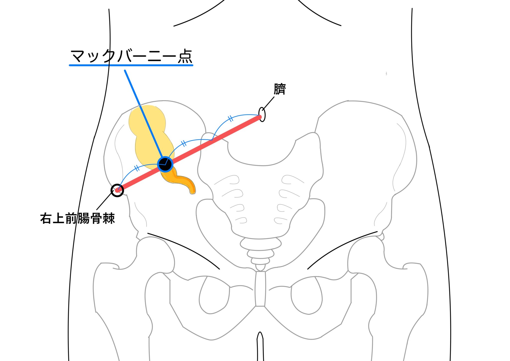 【虫垂炎の圧痛点】試験前に不安ならコレ！マックバーニー点・ランツ点を一発で覚える方法【医学生道場】 | 医学生道場